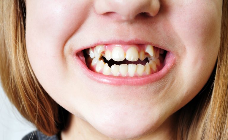 Netaisyklingas sąkandis (dėl kvėpavimo per burną) – Dantistai