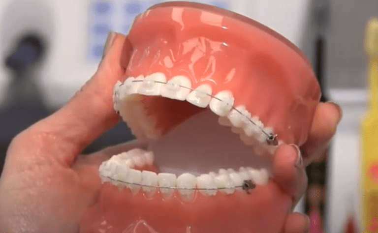 Breketai. Ką reikia žinoti (Video lietuvių k.) – Dantistai