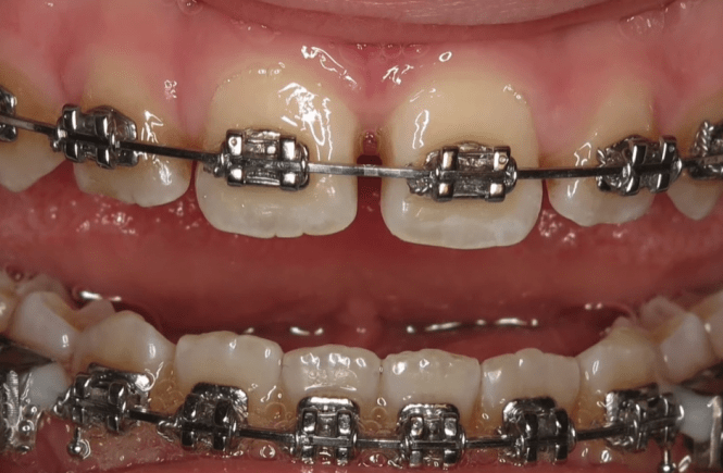 Breketai – Dantistai.lt