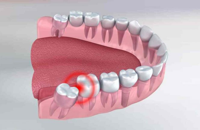 Danties šalinimas – Dantistai.lt