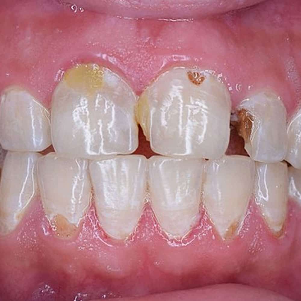 Kaip sustabdyti dantų kariesą (gedimą)? – Dantistai