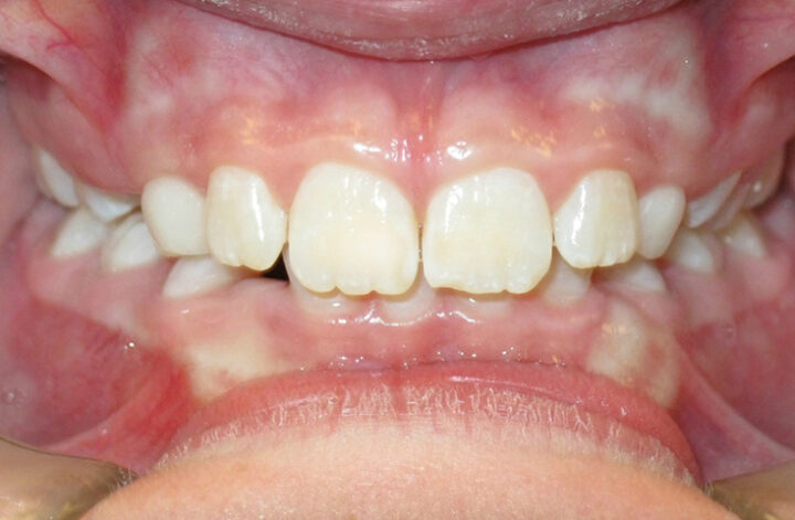 Gilus sąkandis (sukandimas) – Dantistai.lt