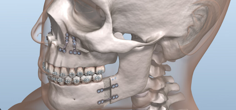 Ortognatinė chirurgija – Dantistai