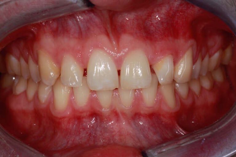 Tarpai tarp dantų: kokie yra galimi „uždarymo” būdai? – Dantistai